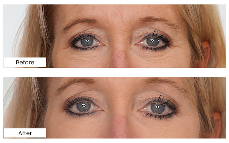 Flash Sale - 3 Instant Under Eye Treatment Pro Formula – SuddenAllure